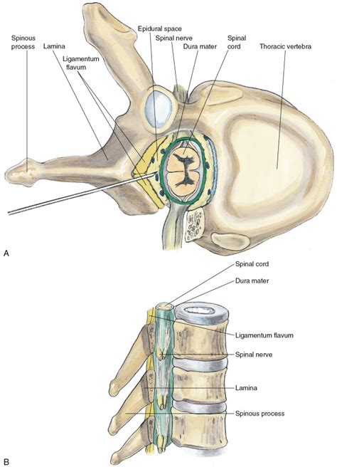 Epidural Block Anesthesia Key