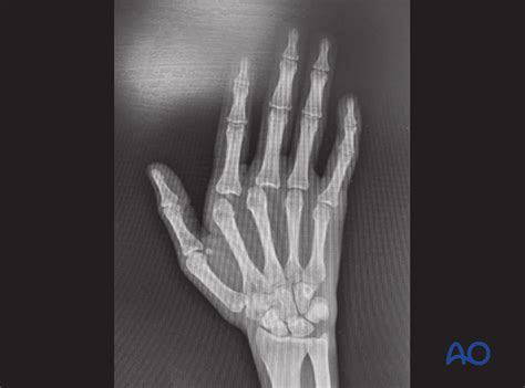 Dislocation And Fracture Dislocation Of The Metacarpophalangeal Joint