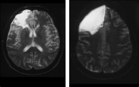 10 Frontal Lobe Resection In Refractory Epilepsy Neupsy Key