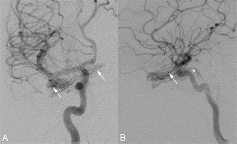 Cerebral DSA Images Of Case Oblique A And Lateral B Images From Download Scientific