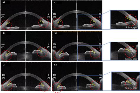 Anterior Chamber Narrow Angle At Joshua Hausman Blog