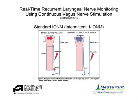 Real Time Recurrent Laryngeal Nerve Intraoperative Monitoring Using Continuous Vagus Nerve