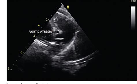 11 Aortic Atresia Ideas Heart Structure Heart Defect Blood Flow
