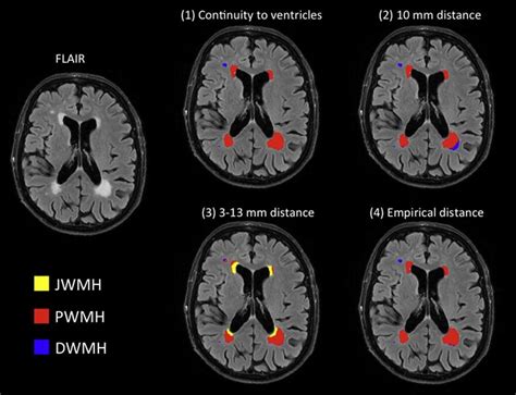 Example Of Wmh Sub Classification Obtained With The Four Criteria