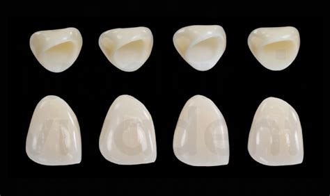 Porcelain Vs Emax Crowns At Carol Hay Blog