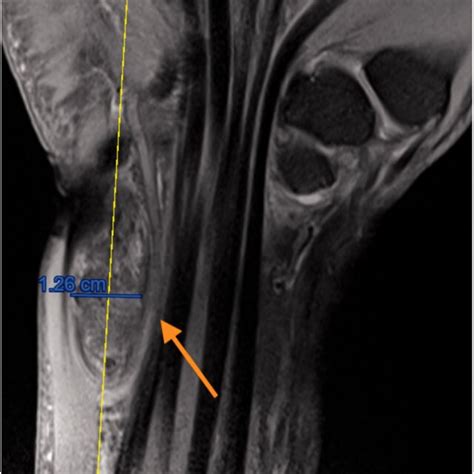 Pre Operative Magnetic Resonance Mri Proton Density Weighted Image