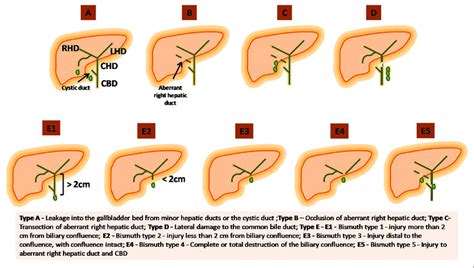 Line Diagram Showing Strasberg Bismuth Classification Of Bile Duct My Xxx Hot Girl