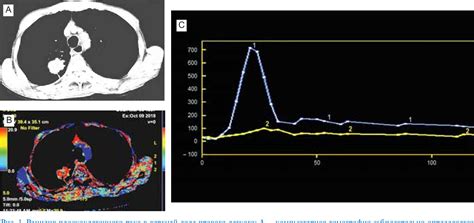 Figure 1 From Perfusion Computer Tomography In Clarifying The Nature Of Pathological Processes
