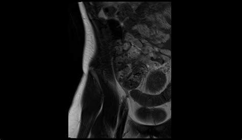 Appendix Mri T2 Tse Coronal Images