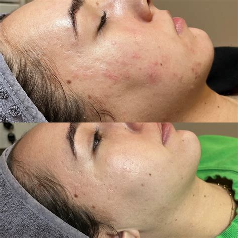 70 Advanced Glycolic Acid Peel Wellness Clinic Chelmsford Essex