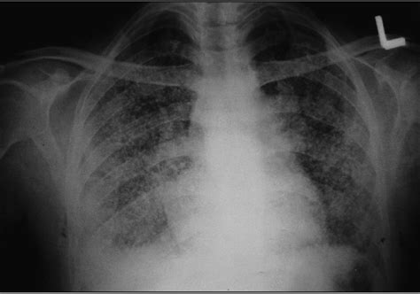 Chest X Ray Showing Dense Micronodular Pattern Download Scientific