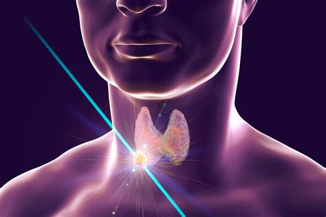 Nodule Thyroïdien Dépistage Types Traitements Santé Magazine