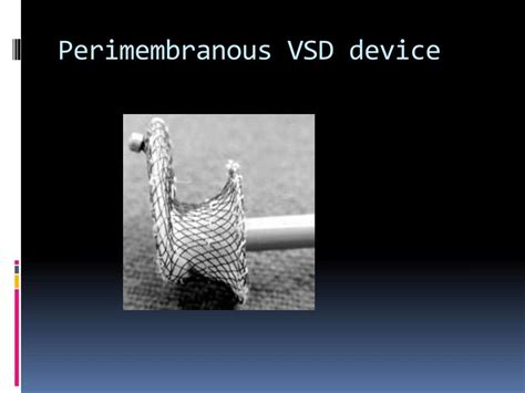 Ppt Transcatheter Closure Of Vsd What Can Be Safely Done Powerpoint