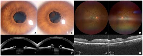 Frontiers Multimodal Optical Imaging Of Iris Flocculi In Three