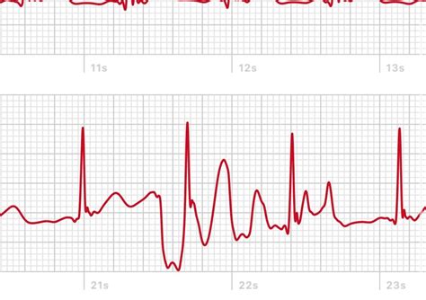 Artifact Or Vtach R Readmyecg