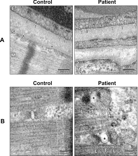 Rippling Muscle Disease Semantic Scholar