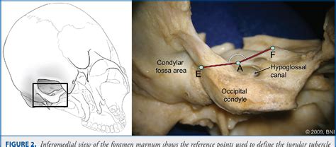 Jugular Tubercle Semantic Scholar