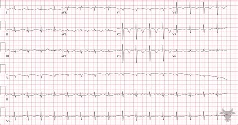 Cerebral T Waves Ecg Stampede