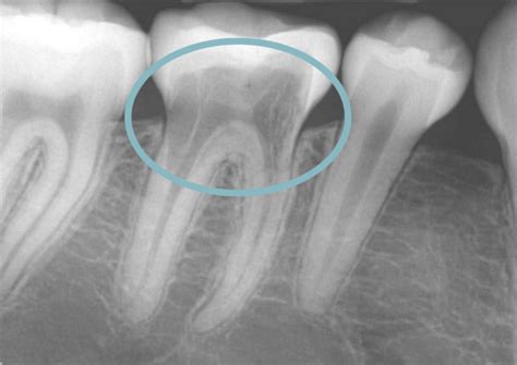 External Root Resorption Symptoms Causes And Treatment