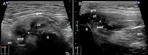 Ultrasound Features Of The Proximal Hamstring Muscle‐tendon‐bone Unit
