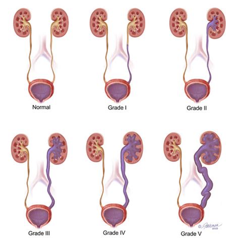 Peds Exam 3 Vesicoureteral Reflux Grading 1 5 Diagram Quizlet