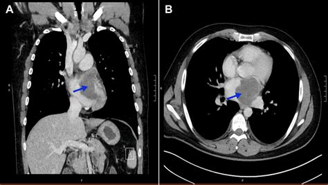 Contrast Enhanced Chest Computed Tomography Showing Nonenhancing Left Download Scientific