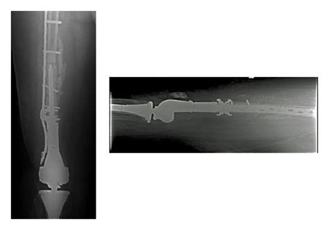 Postoperative Images After Revision Open Reduction Internal Fixation Download Scientific