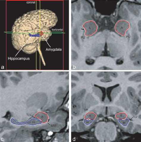 Orthogonal Views For Segmenting The Amygdala And Hippocampus On Mri Download Scientific Diagram