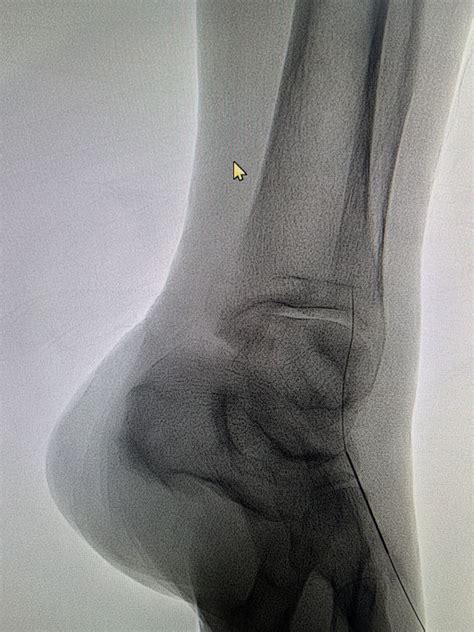 Lijesh Kumar On Linkedin Endovascular Angioplasty Cto Interventional Minimally Pin