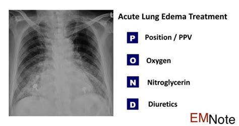Lung Edema Mnemonic Pond Youtu Be Fbtt4xon5ga R Foamed911