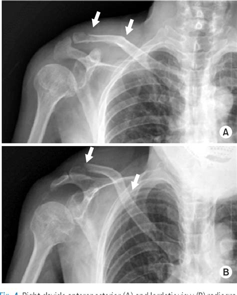 Figure 1 From The Different Treatment Methods For Segmental Fractures Of The Clavicle Cases