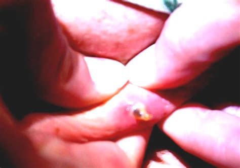 Botfly Human Bot Fly Removal