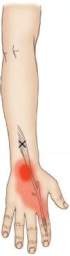 Extensor Indicis Trigger Point Learn Muscles