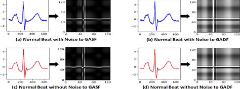 Myocardial Infarction Detection From Ecg A Gramian Angular Field Based 2d Cnn Approach