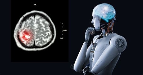 Ai Is Revolutionising Stroke Care 300