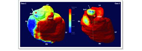 Comparison Between Inverse Potential Mapping And Electroanatomic Download Scientific Diagram