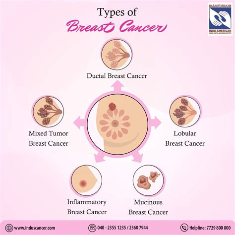 Understanding Breast Cancer A Comprehensive Guide Induscancer