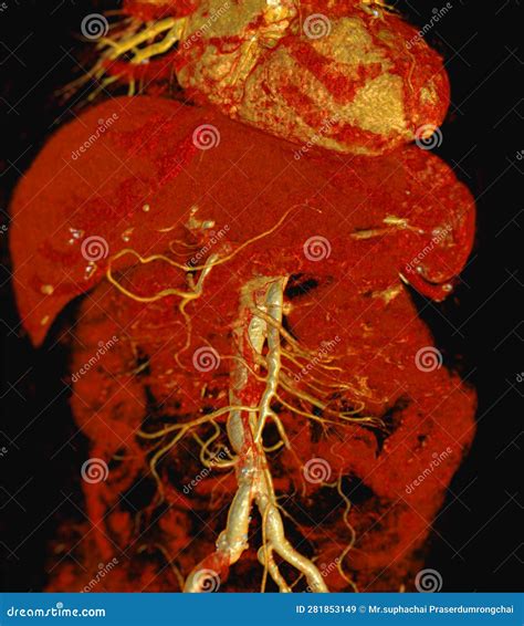 Cta Whole Aorta With Abdominal Aorta Stent Graft Compare 3d Rendering Image Royalty Free Stock