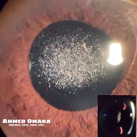 Ahmed Omara On Linkedin Snowflake Degeneration Of Iol