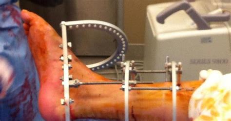 Lower Leg Halo Ankle Dislocation And Achilles Tendon Lengthening Album On Imgur