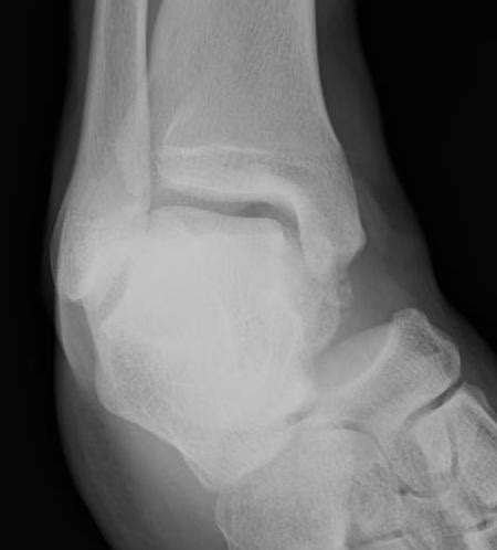 Subtalar Dislocation The Bone Babe