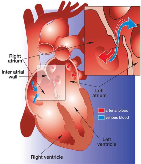 Nobles Medical Technologies Ii Showcases Noblestitch™ Pfo Closure At Europcr Cardiac Vascular News