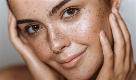 Profhilo A Powerful Injectable Moisturiser