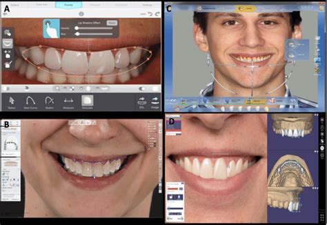 Digital Smile Design Softwares A Smile Designer Pro B 3Shape Smile Download Scientific