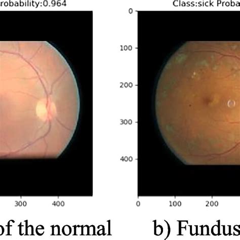 Retinal Fundus Image Two Classification Accuracy And Loss Values Download Scientific Diagram