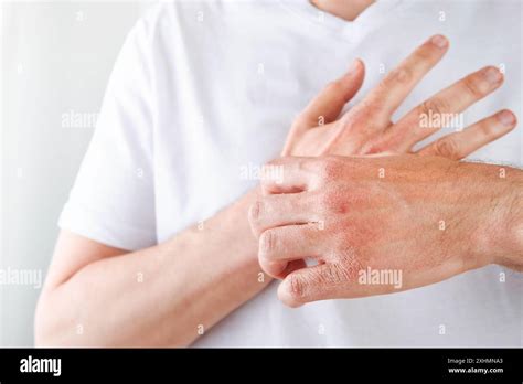 Man Scratches Or Shows Hands With Dry Cracked Skin On White
