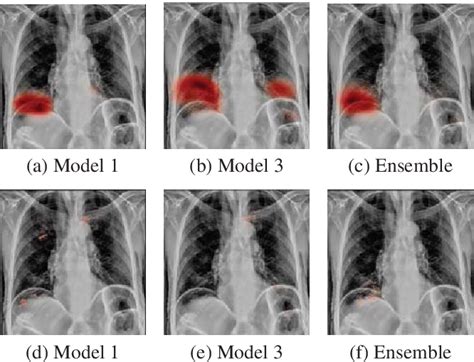 figure 4 from pneumoperitoneum detection in chest x ray by a deep