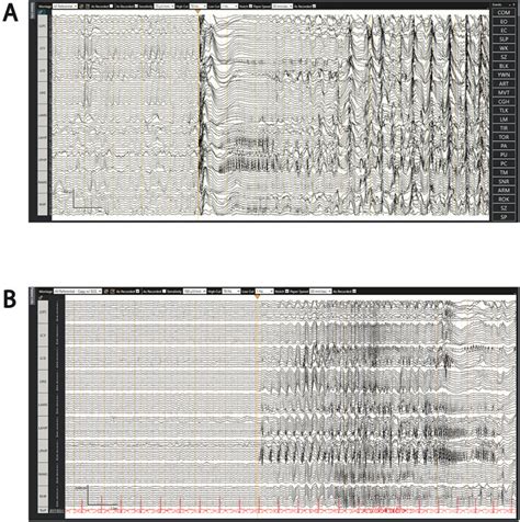Using Chronic Recordings From A Closed‐loop Neurostimulation System To Capture Seizures Across