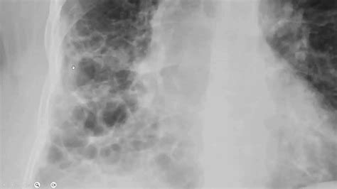 Chest Xray In Bronchiectasis Findings Radiology Cxr Youtube