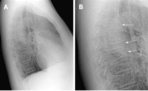 Incidental Vertebral Compression Fractures On Chest Radiograph A